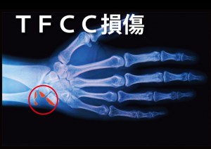 TFCC損傷による手首の痛みの治療法！